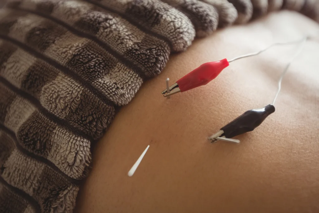 Maximize Reimbursement with 97813 CPT Code for Electroacupuncture